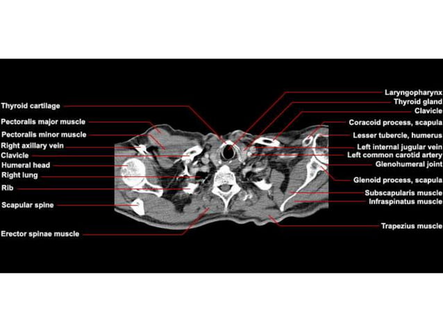 CT Thorax Soft Tissue Axial.pptx