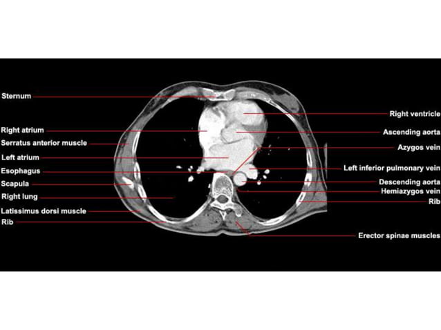 CT Thorax Soft Tissue Axial.pptx