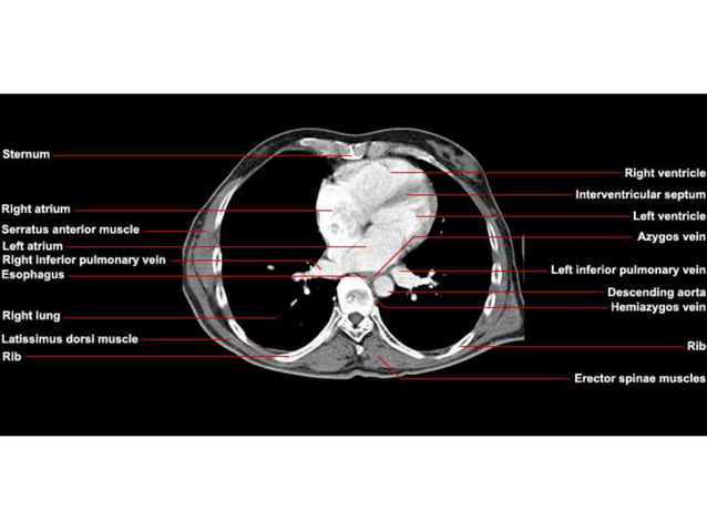CT Thorax Soft Tissue Axial.pptx