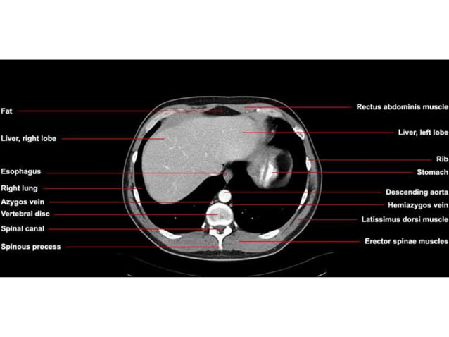 CT Thorax Soft Tissue Axial.pptx