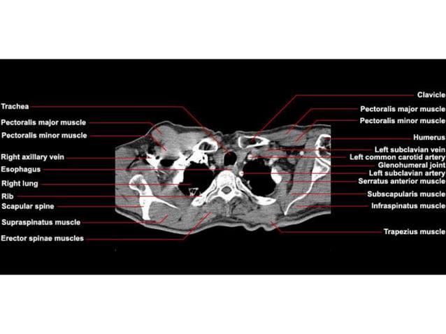 CT Thorax Soft Tissue Axial.pptx