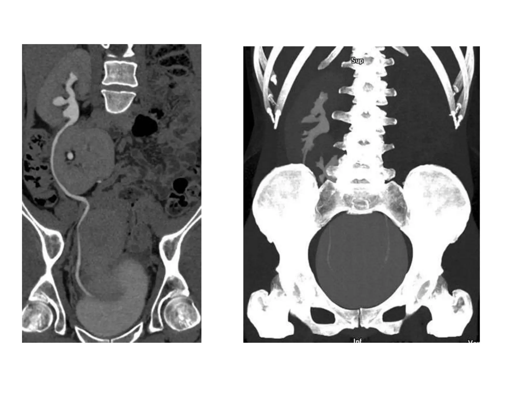 CT Urography | PPTX