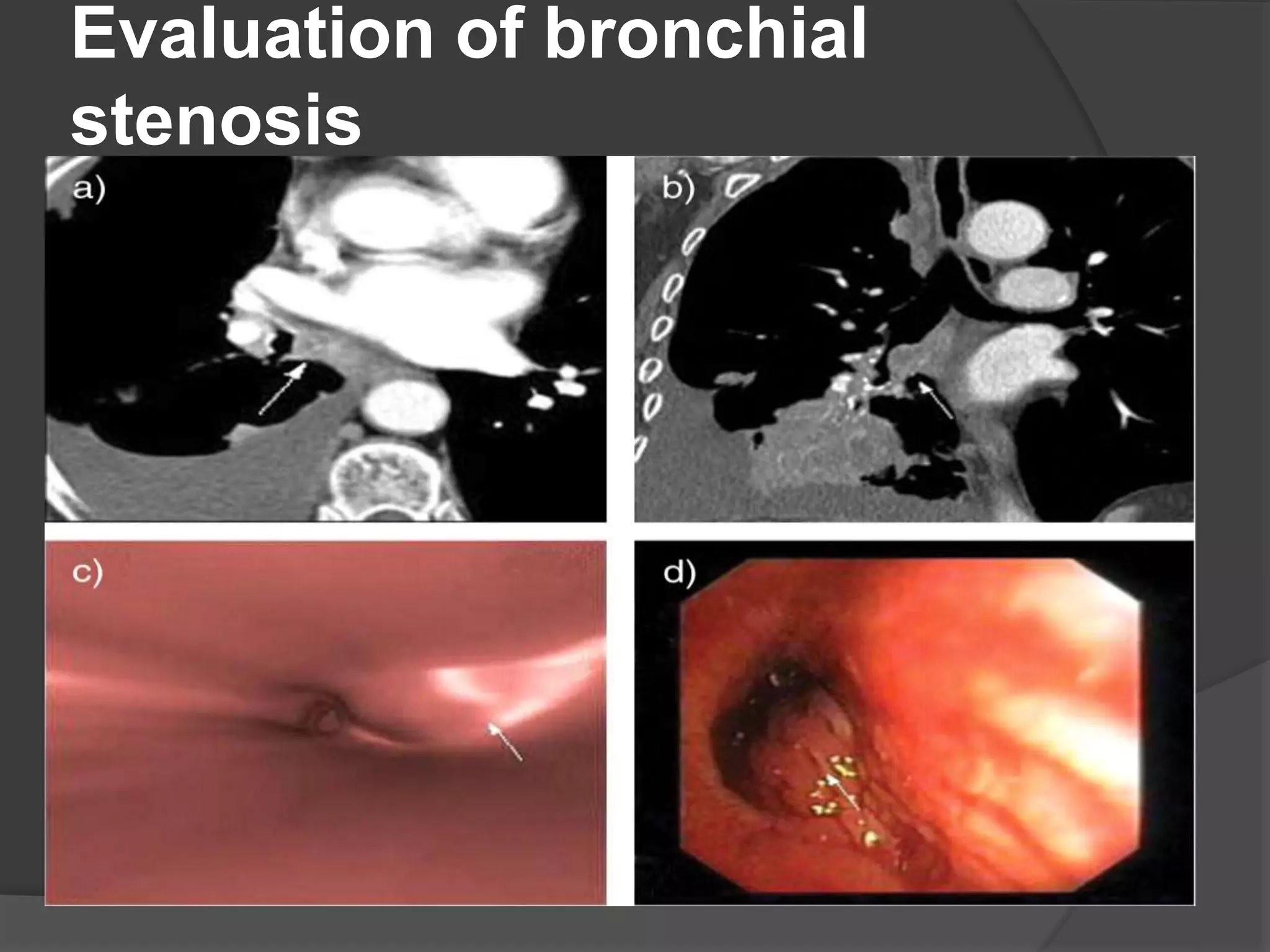 Ct virtual endoscopy 1 | PPTX