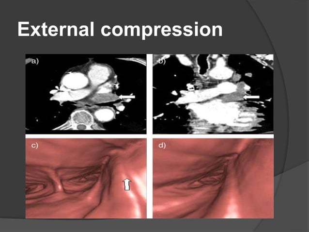 Ct virtual endoscopy 1 | PPTX | Digestive Disorders | Diseases and ...