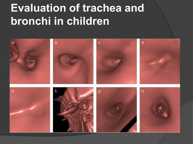 Ct virtual endoscopy 1 | PPTX | Digestive Disorders | Diseases and ...