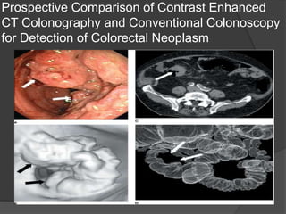 Ct virtual endoscopy 1 | PPTX
