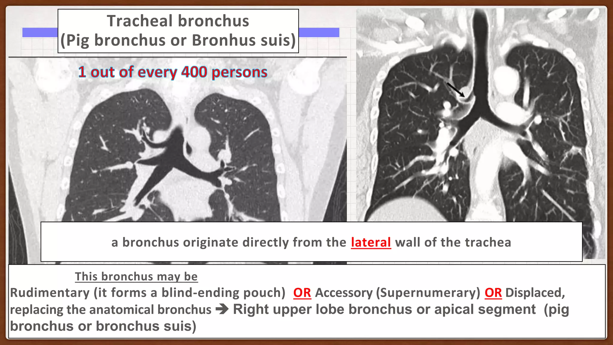 Looking at the windpipe in CT chest (dr eid elagamy).pptx | Lung and ...