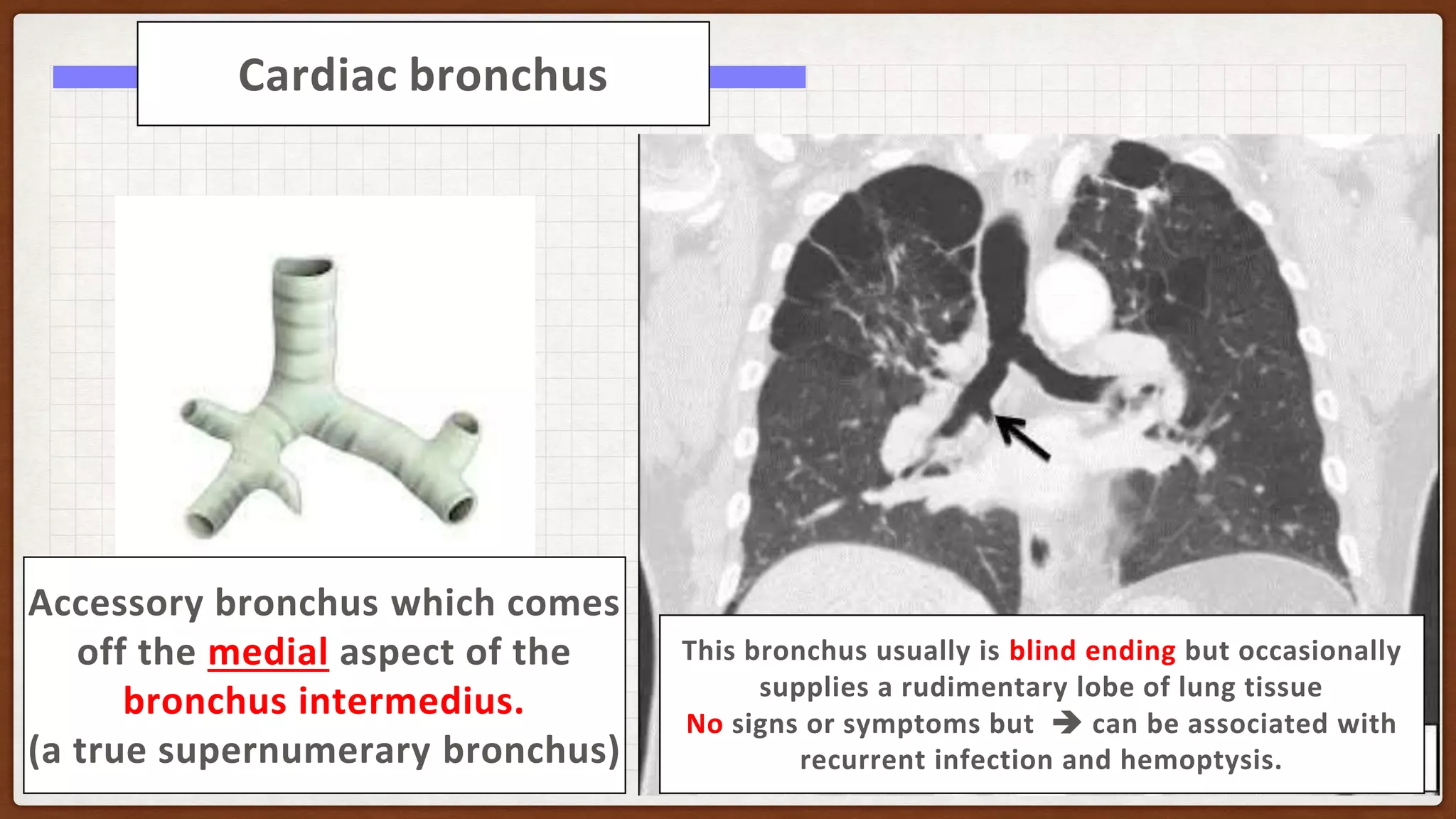 Looking at the windpipe in CT chest (dr eid elagamy).pptx | Lung and ...