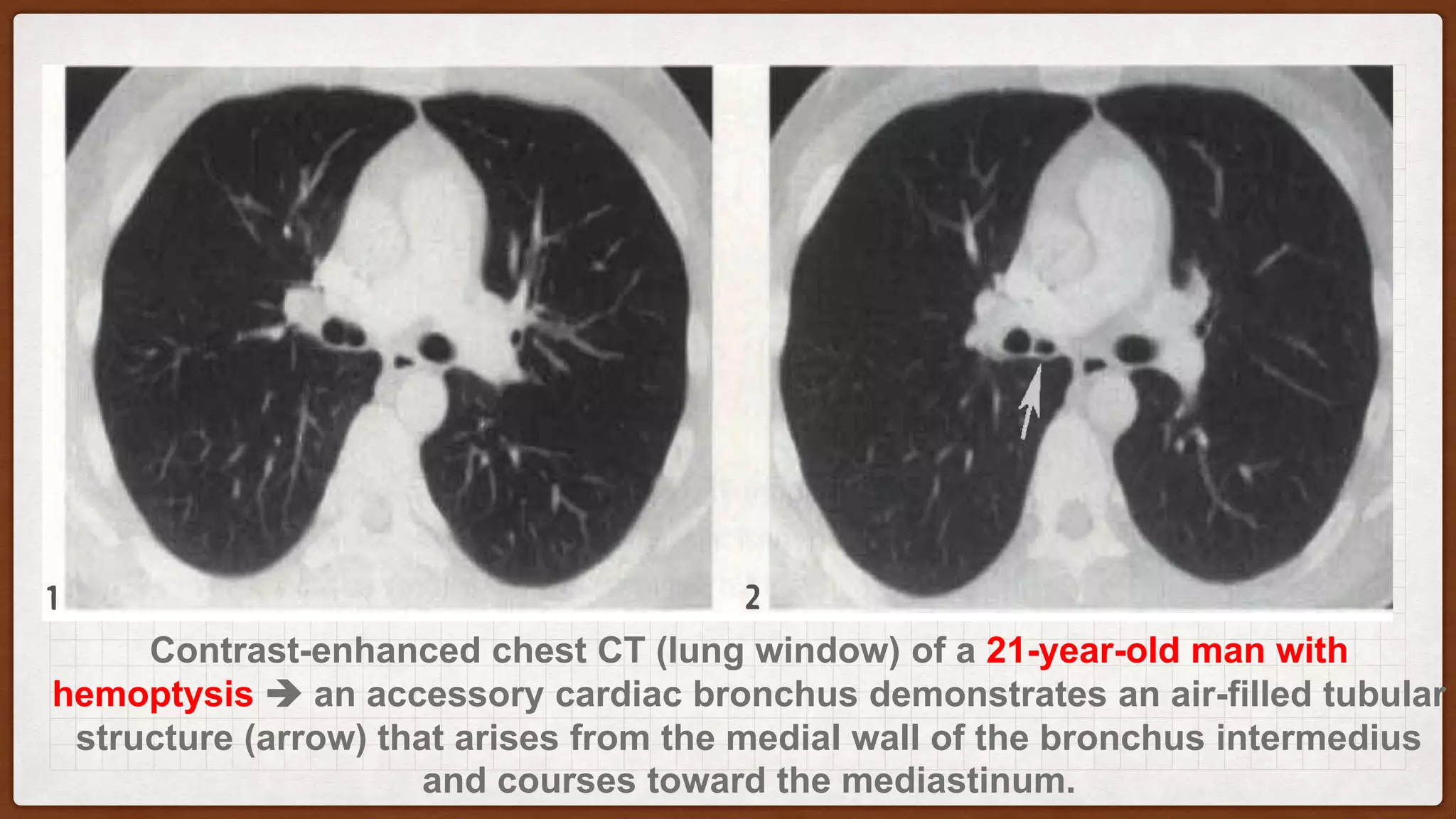 Looking at the windpipe in CT chest (dr eid elagamy).pptx | Lung and ...
