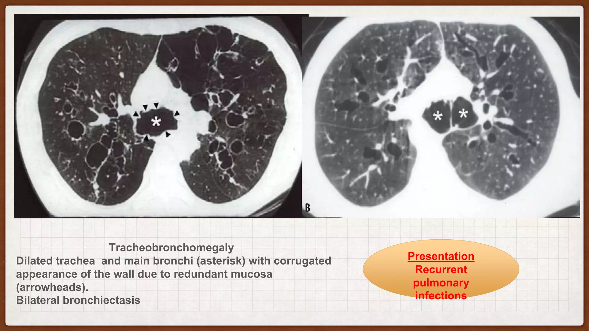 Looking at the windpipe in CT chest (dr eid elagamy).pptx | Lung and ...