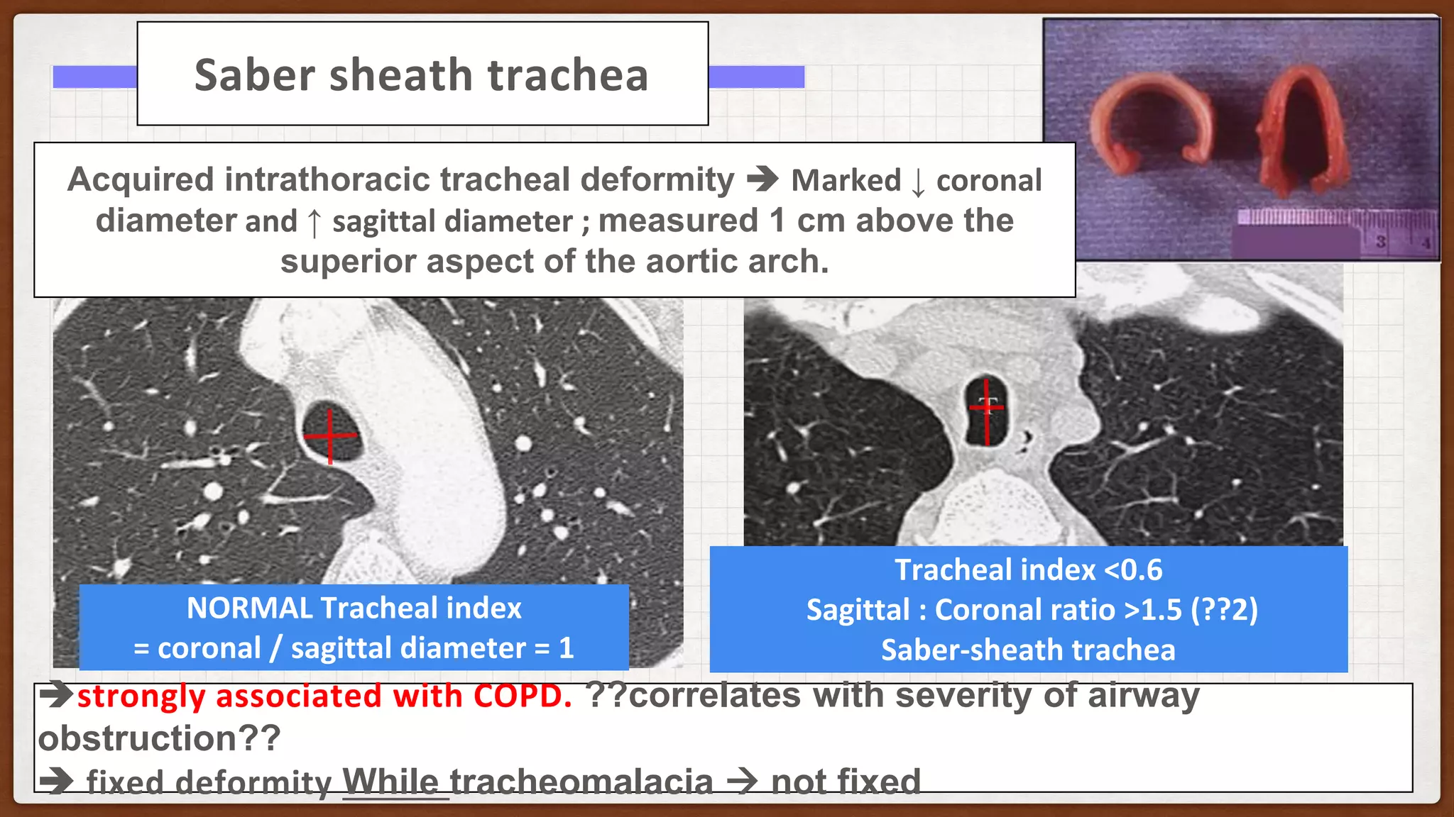 Looking at the windpipe in CT chest (dr eid elagamy).pptx | Lung and ...