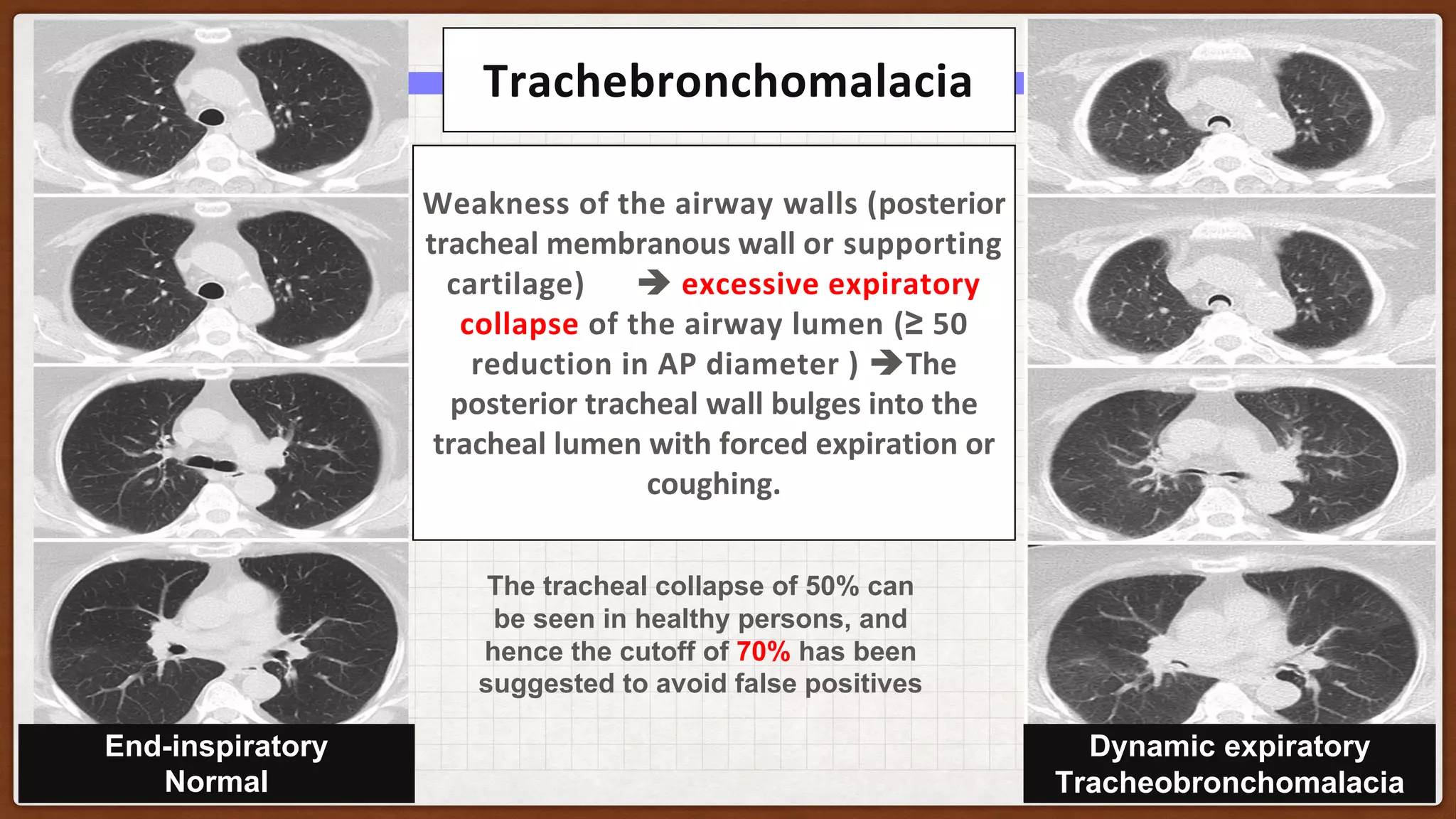 Looking at the windpipe in CT chest (dr eid elagamy).pptx | Lung and ...