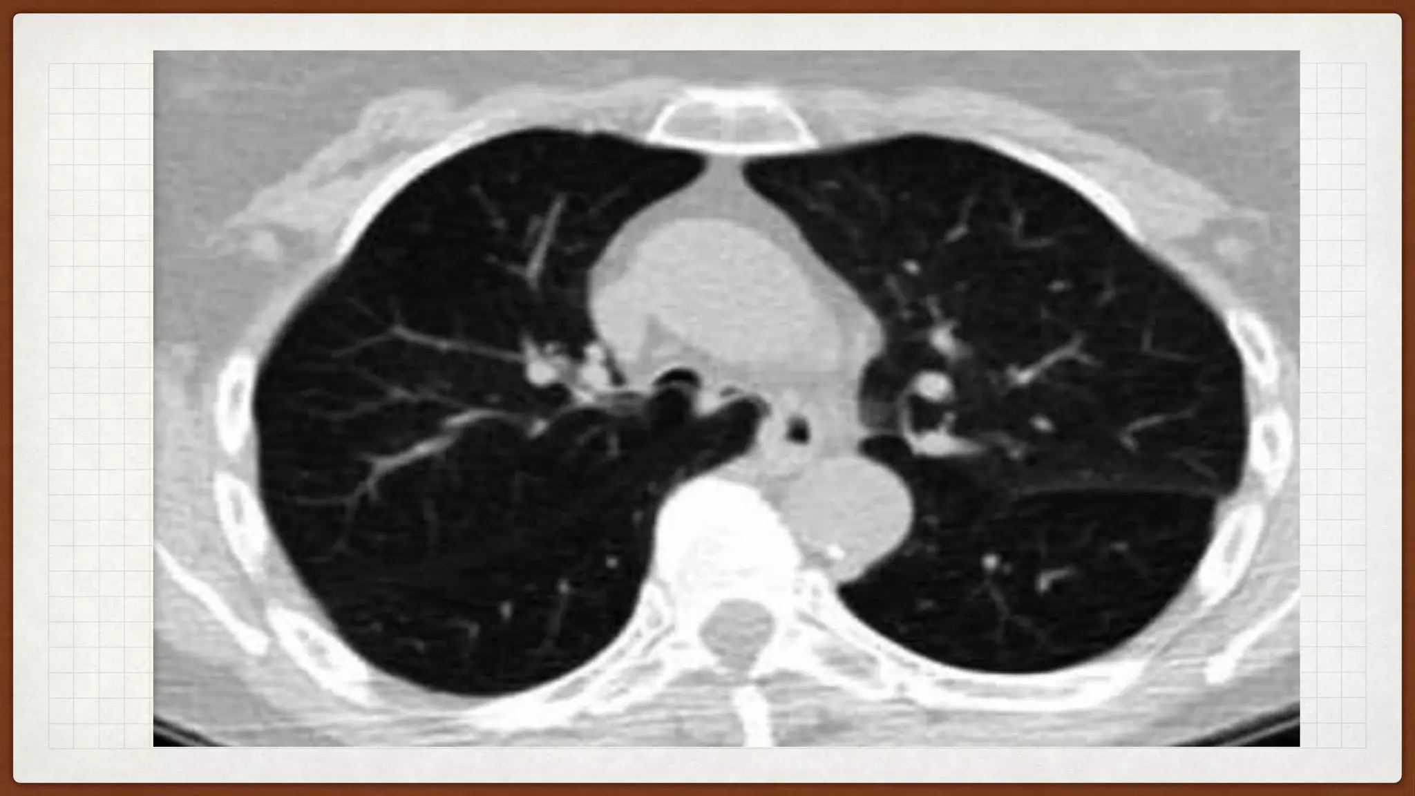 Looking at the windpipe in CT chest (dr eid elagamy).pptx | Lung and ...