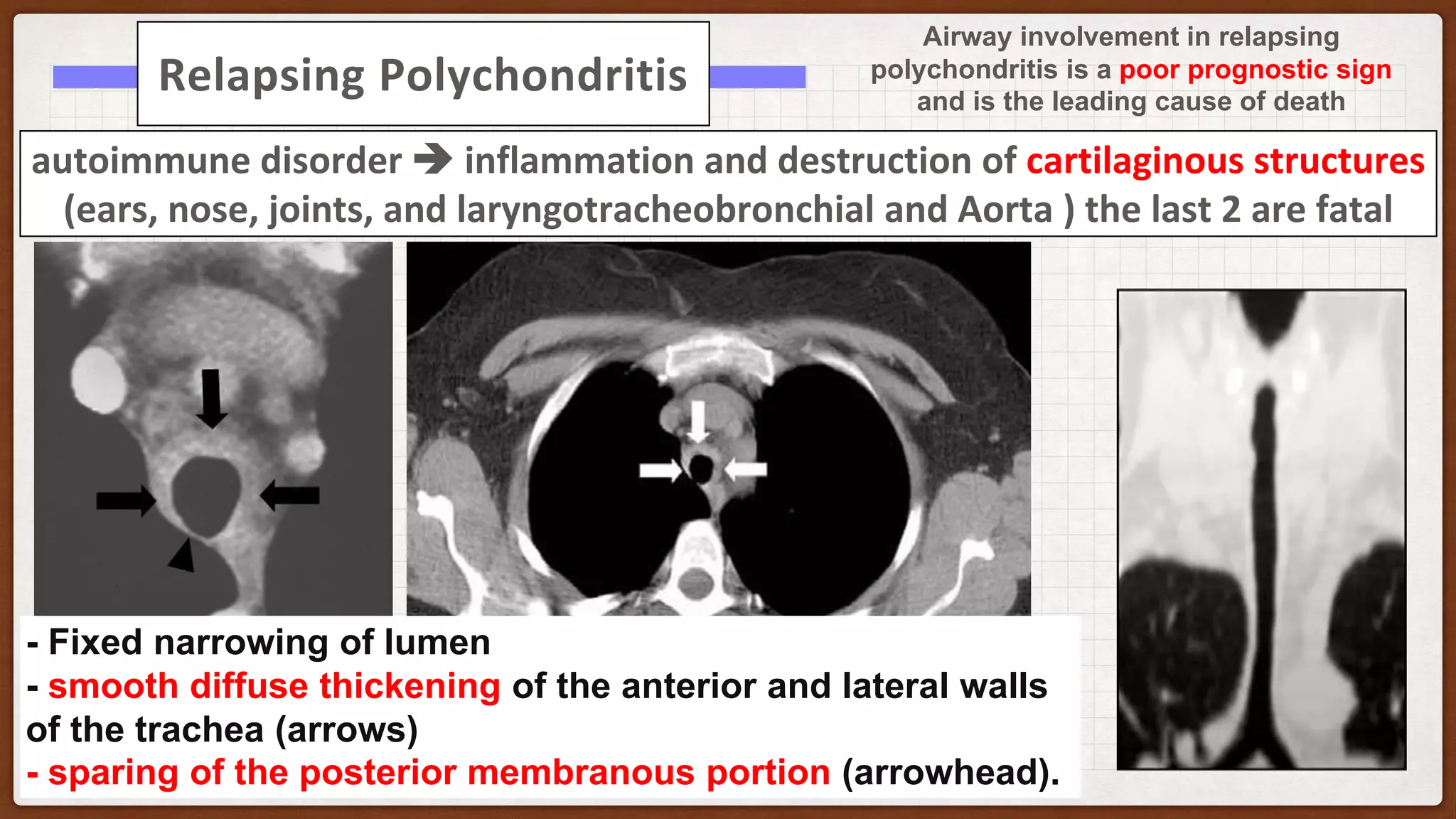 Looking at the windpipe in CT chest (dr eid elagamy).pptx | Lung and ...
