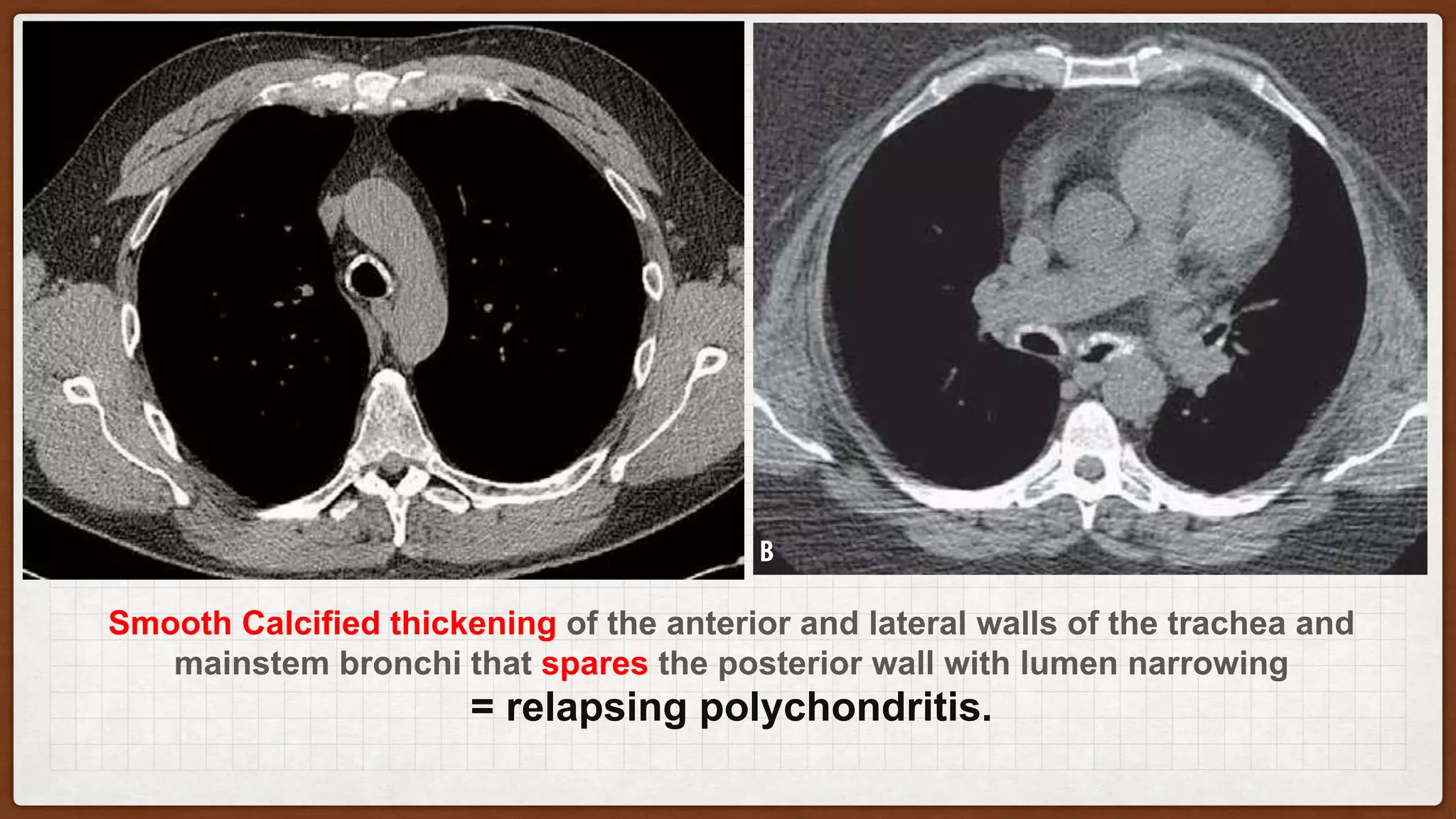 Looking at the windpipe in CT chest (dr eid elagamy).pptx | Lung and ...