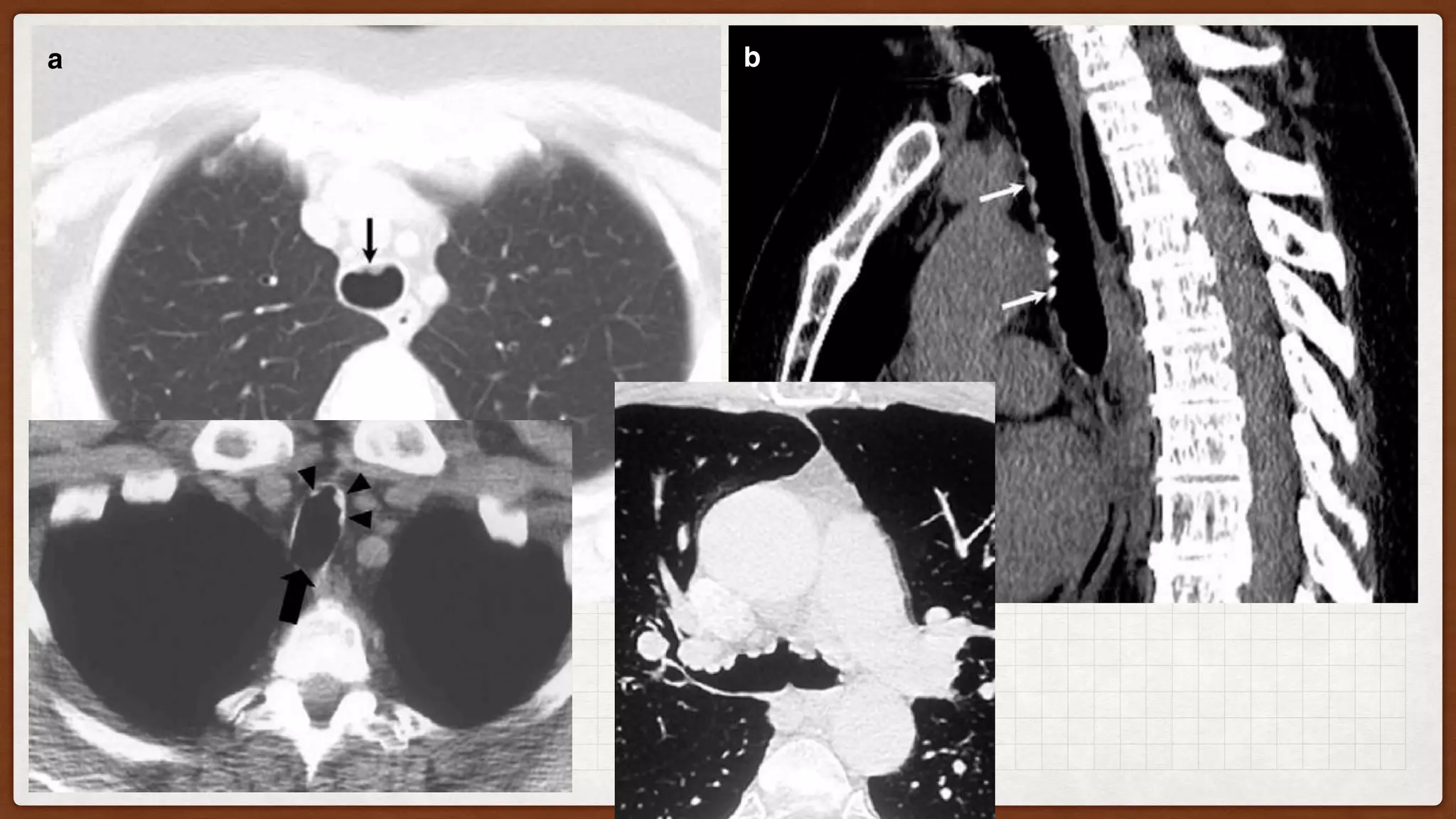 Looking at the windpipe in CT chest (dr eid elagamy).pptx | Lung and ...