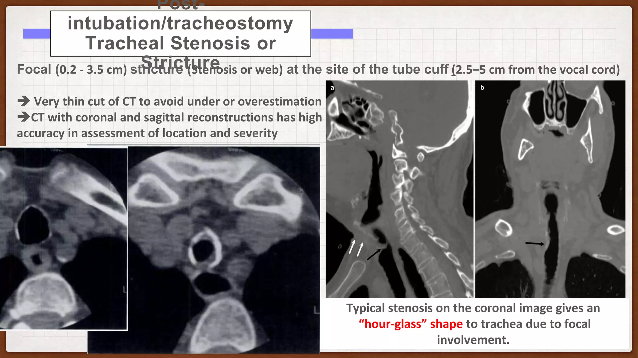 Looking at the windpipe in CT chest (dr eid elagamy).pptx | Lung and ...