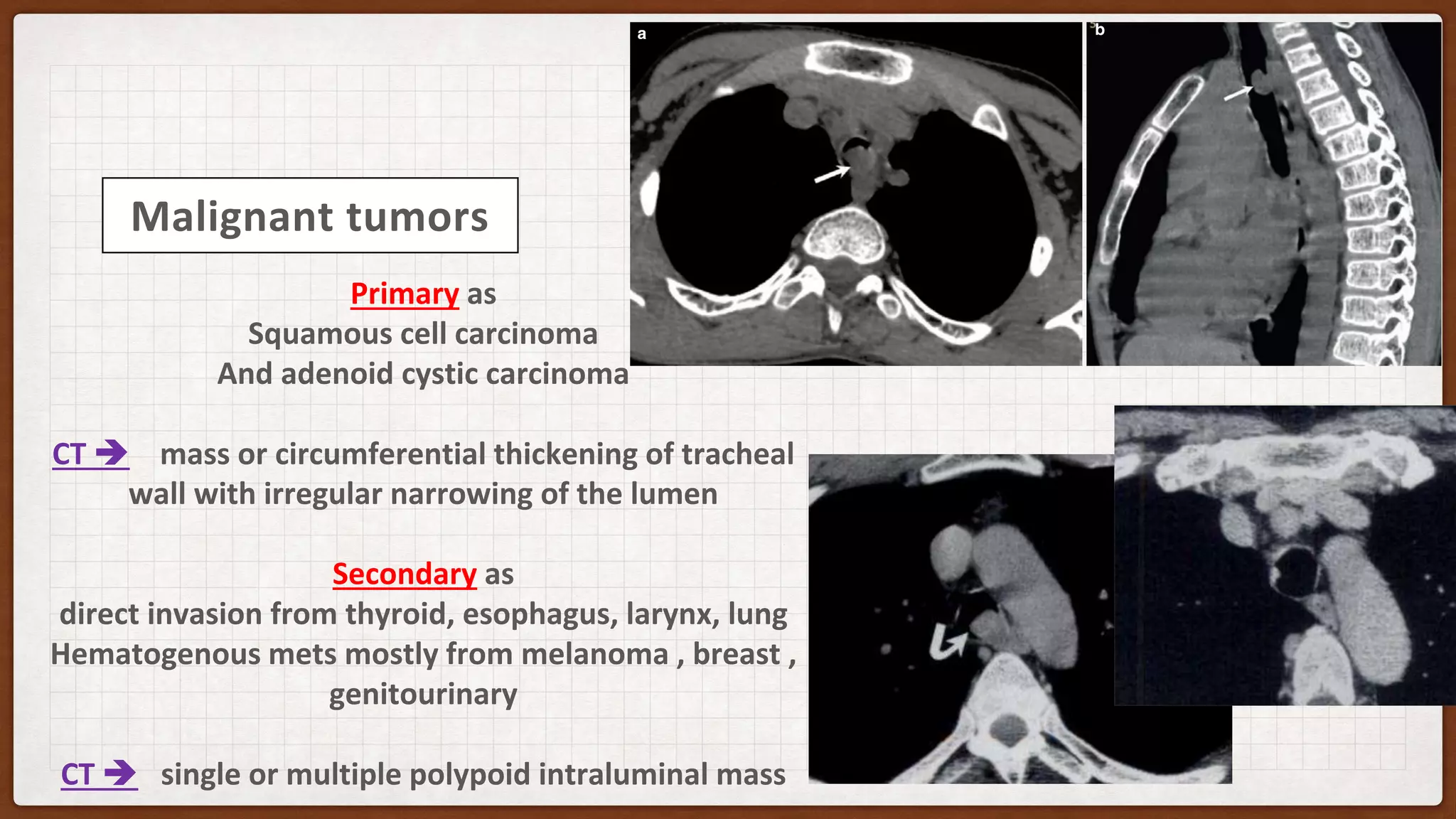 Looking at the windpipe in CT chest (dr eid elagamy).pptx | Lung and ...