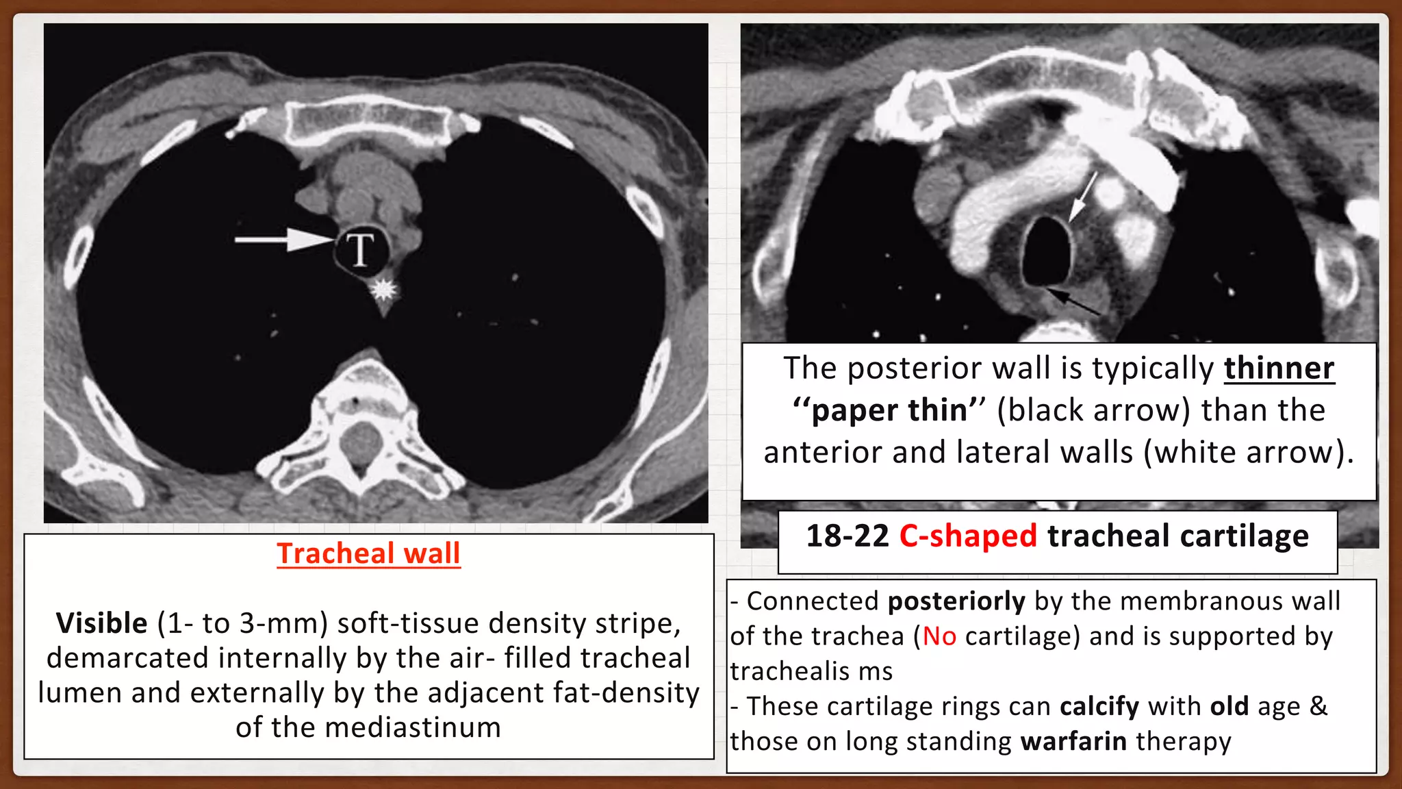 Looking at the windpipe in CT chest (dr eid elagamy).pptx | Lung and ...