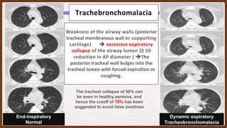 Looking at the windpipe in CT chest (dr eid elagamy).pptx | Lung and ...