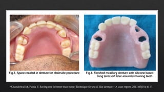 Cu-Sil Dentures in prosthodontics a Journal club | PPTX