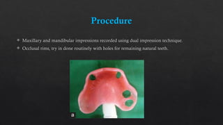 Cu-Sil Dentures in prosthodontics a Journal club | PPTX