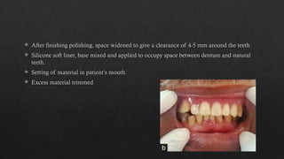 Cu-Sil Dentures in prosthodontics a Journal club | PPT