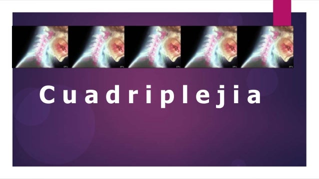 Cuadriplejia o tetraplejia