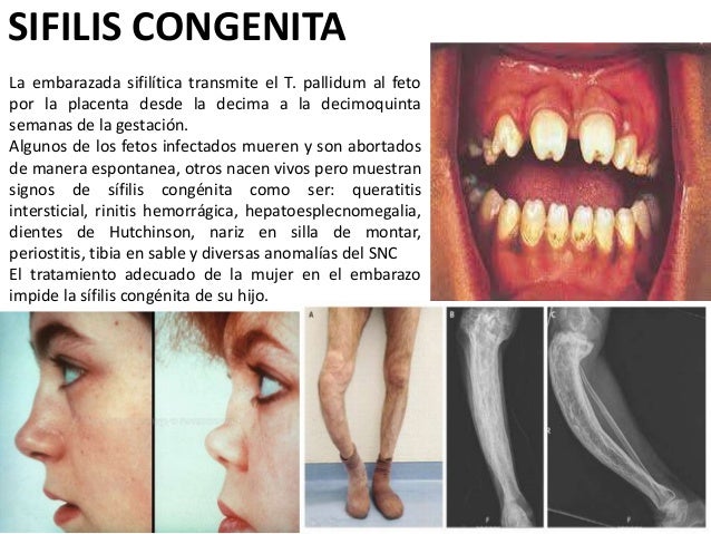 Cuadro clinico de sifilis