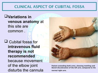 SURFACE ANATOMY OF CUBITAL FOSSA,ITS BOUNDRIES,STRUCTURES AND THEIR ...