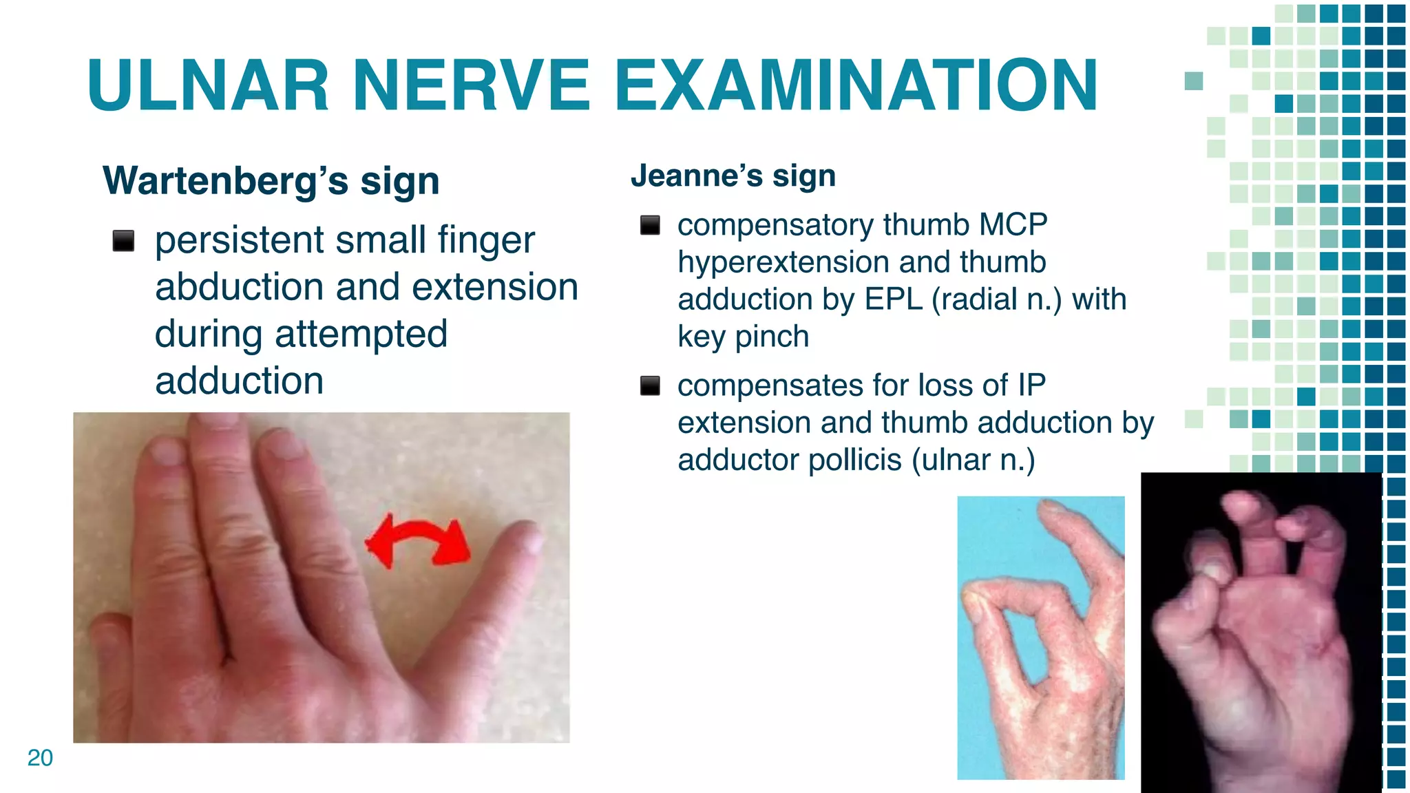 Cubital tunnel syndrome 1 | PDF