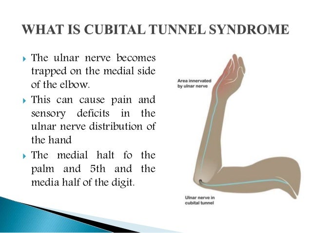 Cubital tunnel syndrome: Causes, symptoms, diagnosis and treatment