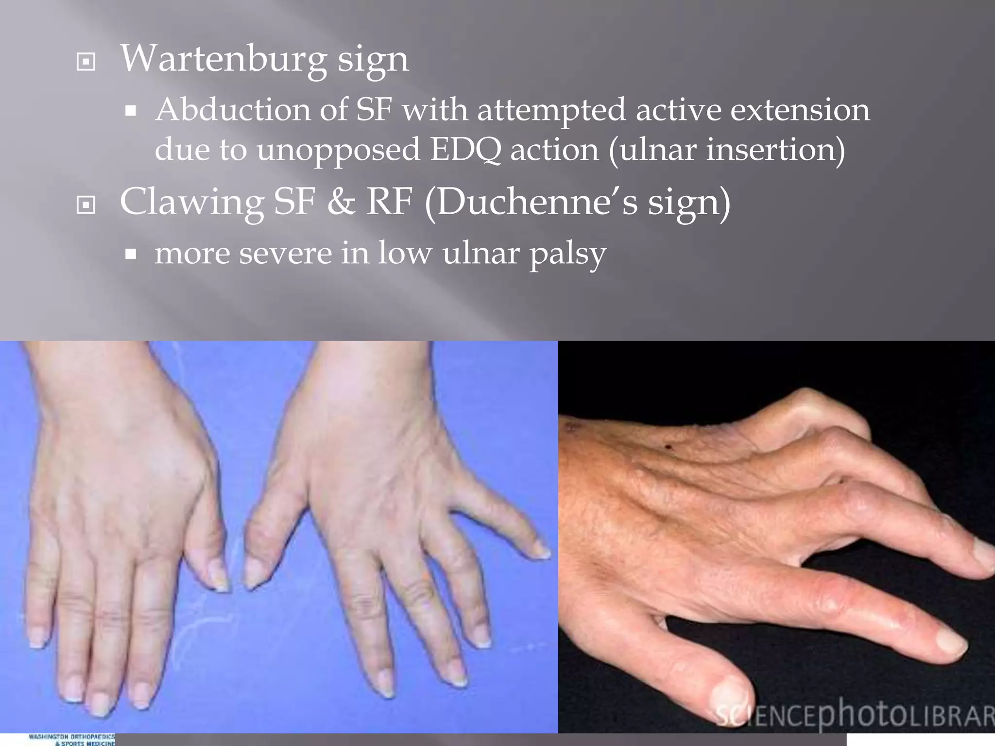 Cubital Tunnel Syndrome and Carpal Tunnel Syndrome: Current Concepts | PPTX