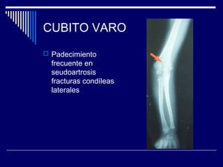 Cubito Varo Ppt