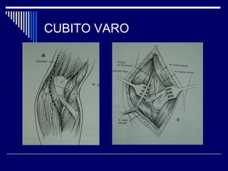 Cubito varo | PPT