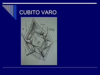 Cubito varo | PPT