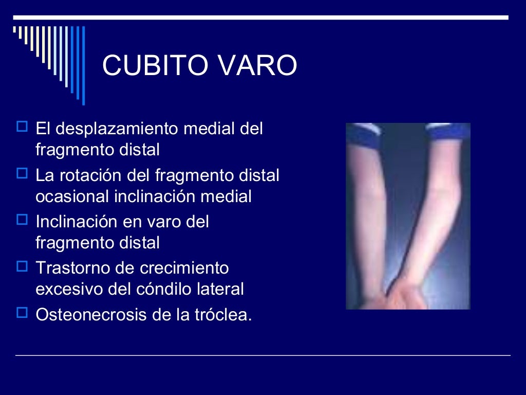 Cubito varo