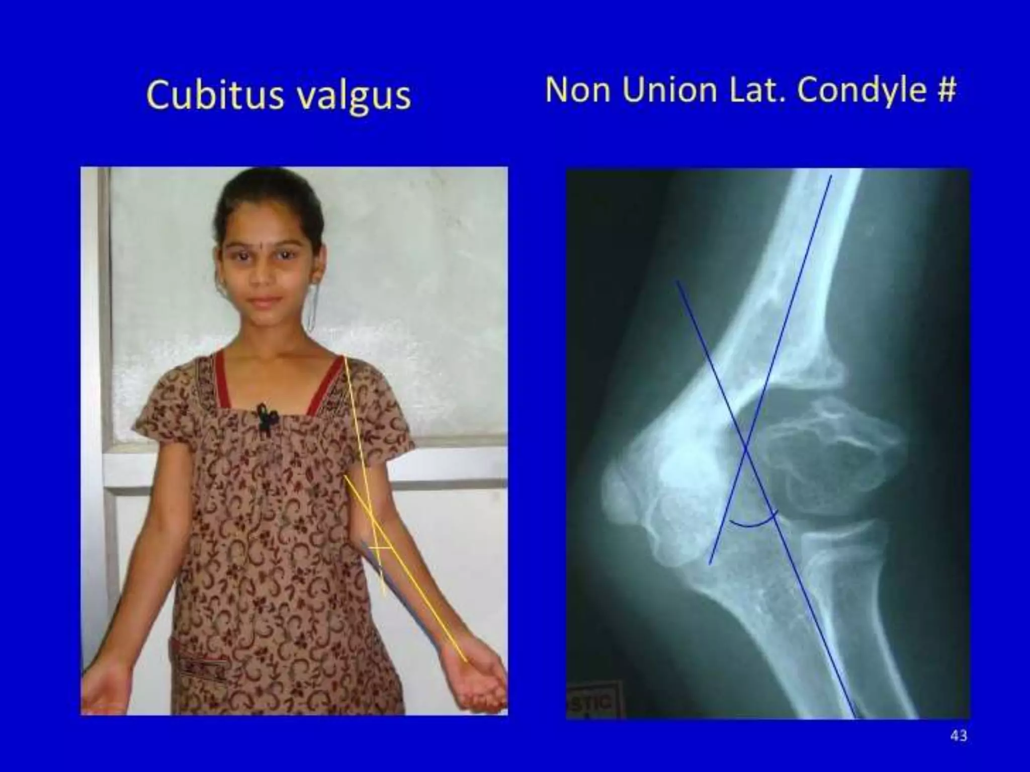 Cubitus valgus | PPTX