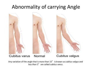 Cubitus valgus | PPTX