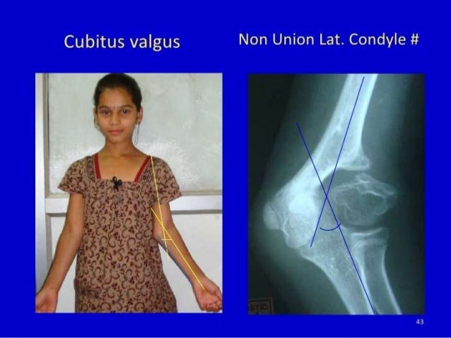 Cubitus valgus