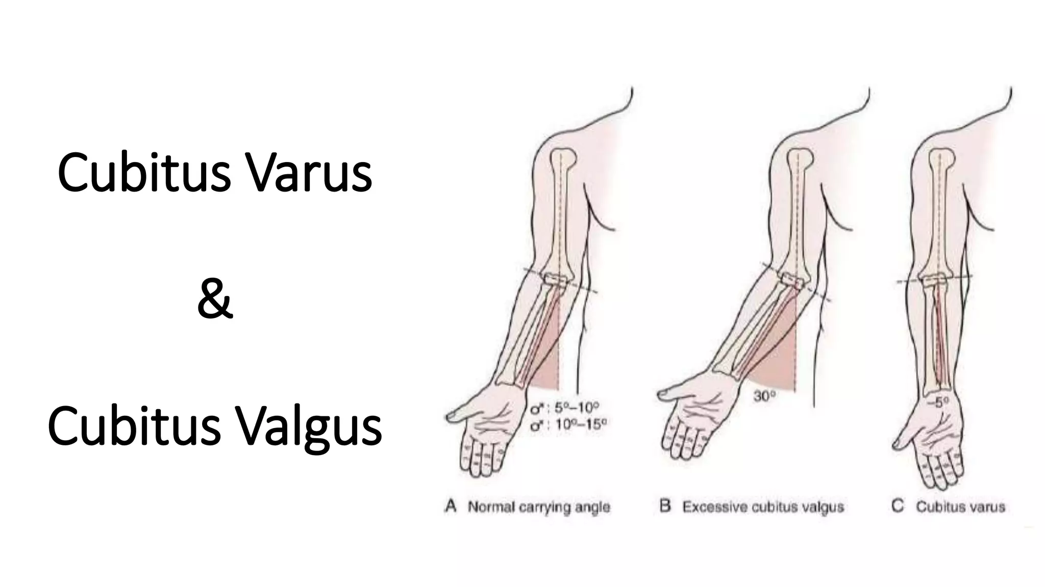 Cubitus valgus varus | PPTX