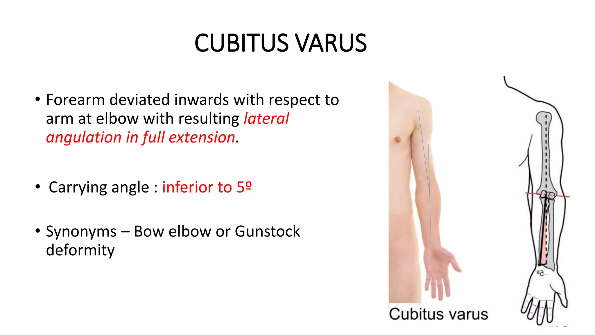 Cubitus valgus varus | PPTX