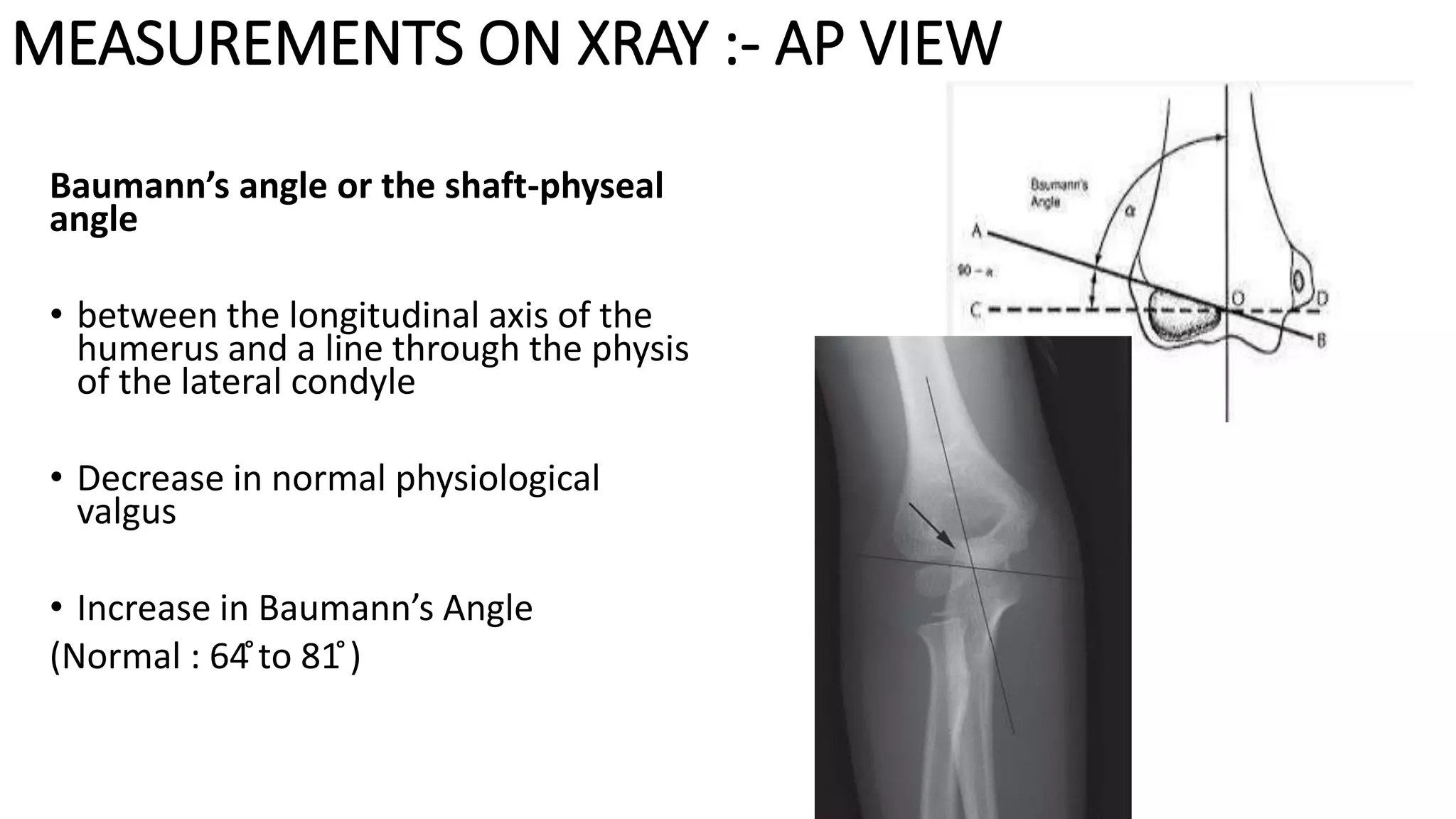Cubitus valgus varus | PPTX