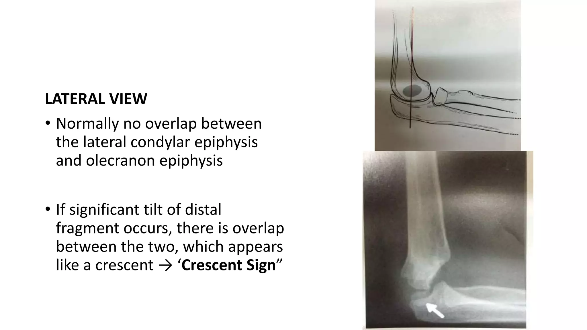 Cubitus valgus varus | PPTX