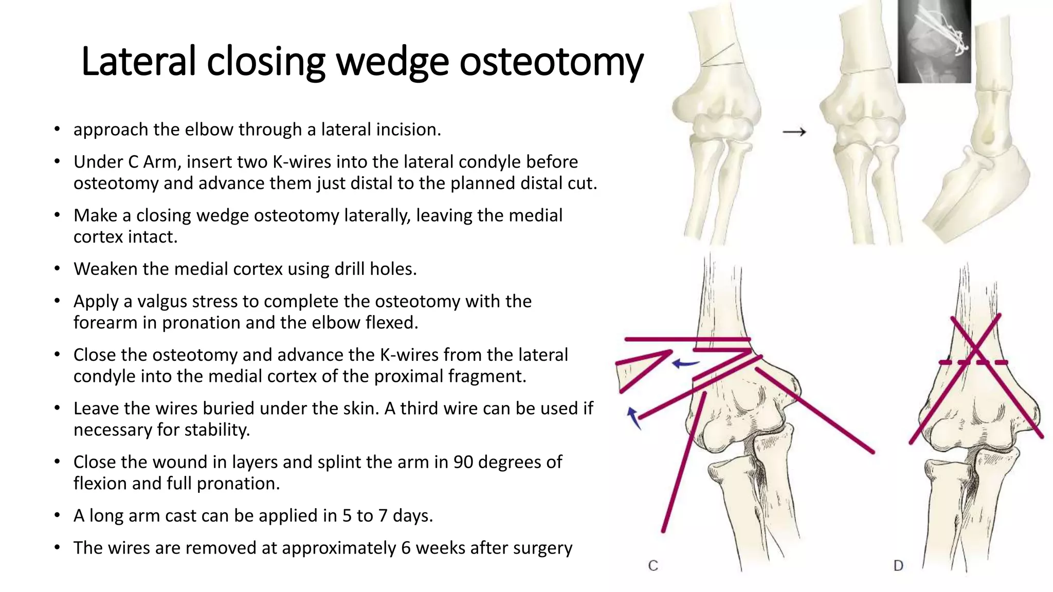 Cubitus valgus varus | PPTX