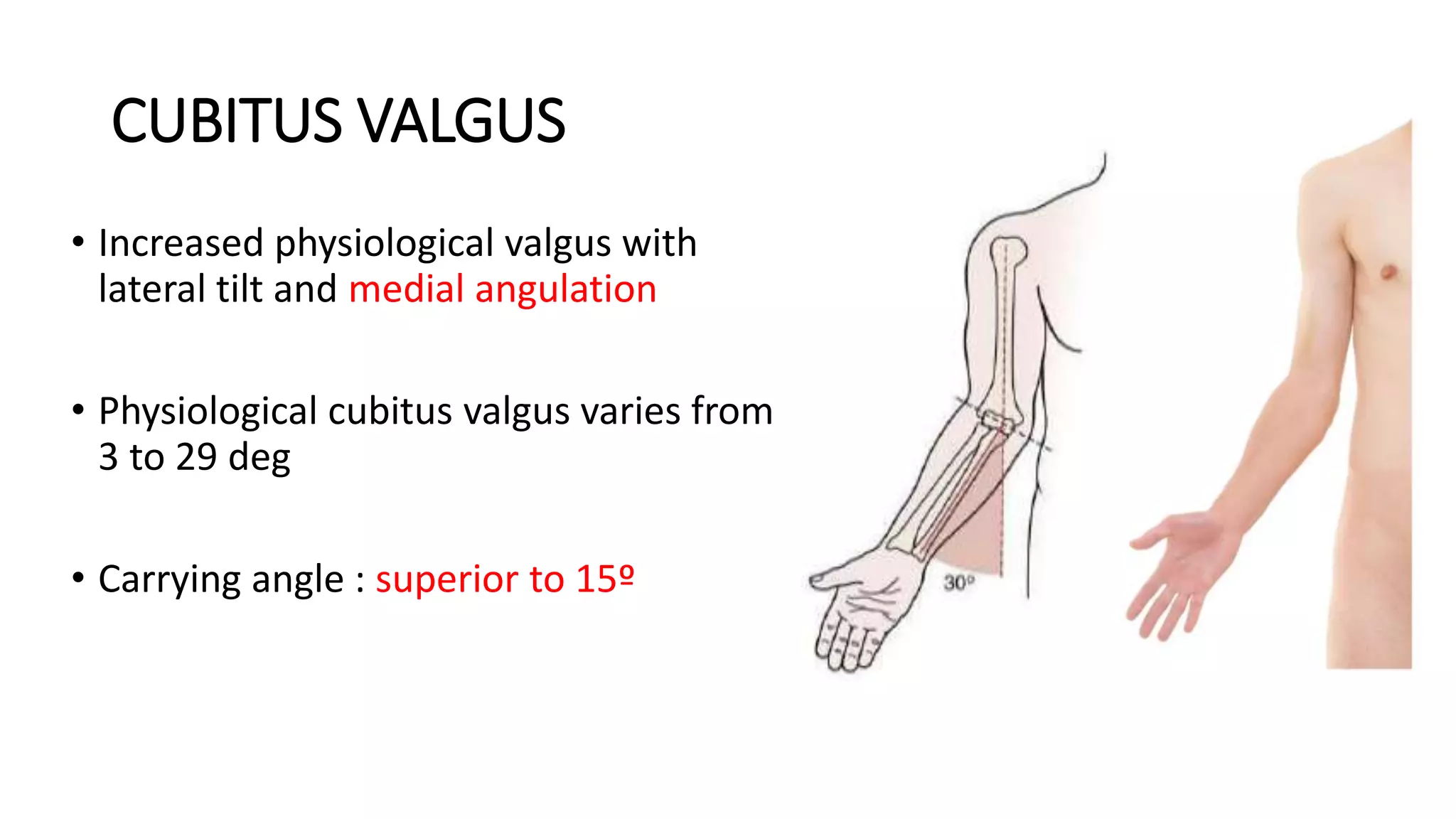 Cubitus valgus varus | PPTX