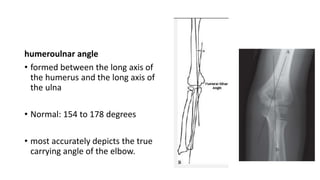 Cubitus valgus varus | PPTX