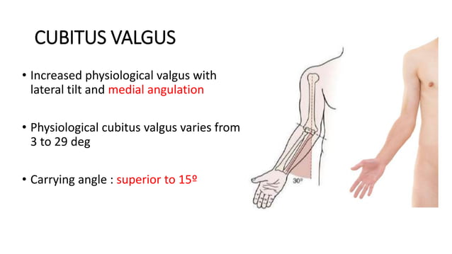 Cubitus valgus varus | PPTX | Death, Injury, or Military Conflict ...