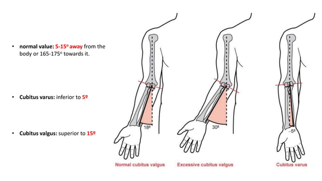 Cubitus valgus varus | PPTX | Death, Injury, or Military Conflict ...