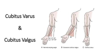 Cubitus Valgus And Cubitus Varus